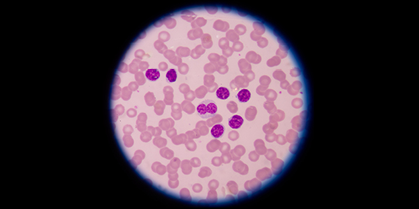 Managing Patients with CLL on BTK Inhibitor Therapy | myCME