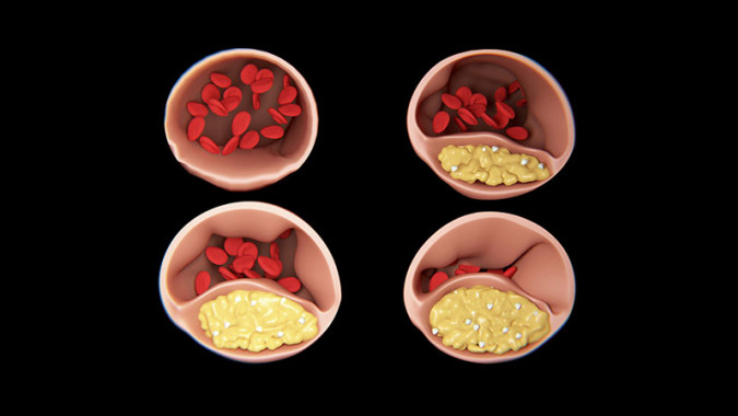 Decision Points in CVD – Reducing Risk for ASCVD Prevention | NACE