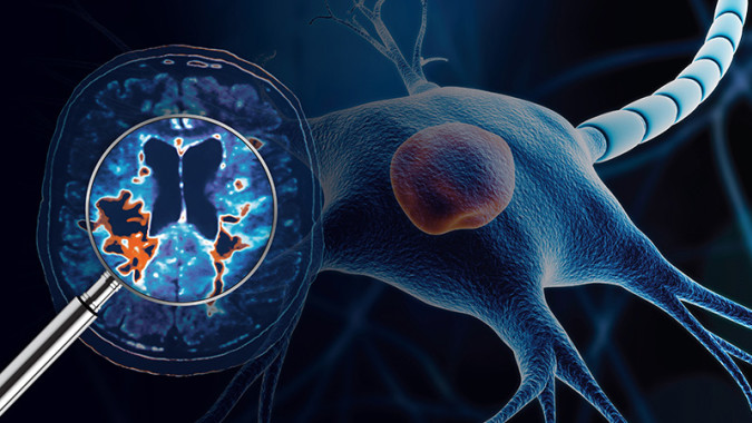 Evidence Based Management of Progressive MS | myCME