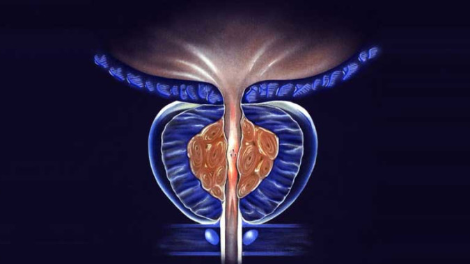 PUL and Other Minimally Invasive Technologies for LUTS Due to BPH