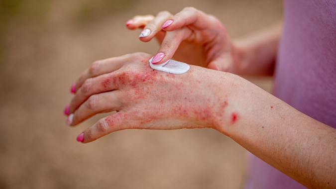 Comparing Atopic Dermatitis Topical Therapies | myCME