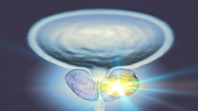 Androgen Deprivation Therapy (ADT) in Advanced Prostate Cancer | myCME