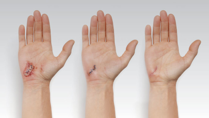 Infection Prevention Strategies in Wound Care | myCME