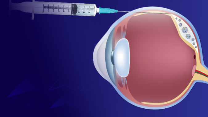 Latest Advances in X-Linked Retinitis Pigmentosa | myCME Latest Advances in X-Linked Retinitis Pigmentosa | myCME