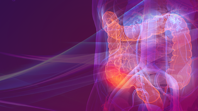 Iron Deficiency Therapy in Inflammatory Bowel Disease | myCME