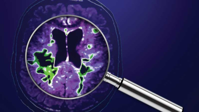 A New Chapter in the Management of Progressive MS | myCME