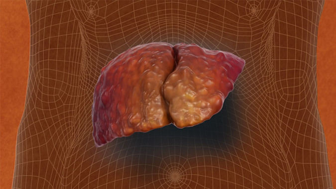 Early-Stage Detection of Hepatocellular Carcinoma | myCME