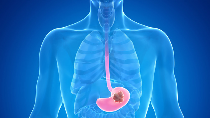 Managing HER2-Positive Gastric and GEJ Cancer | myCME