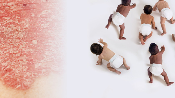 Infants and Atopic Dermatitis | myCME