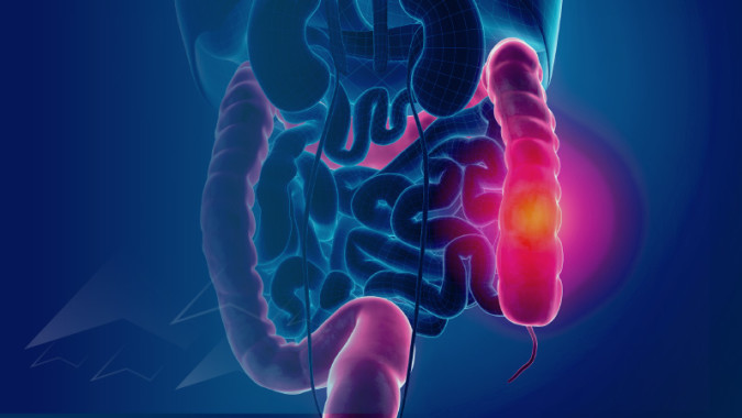 Individualized treatment plans for patients with IBD | myCME