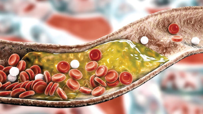 Dyslipidemia and Treatment Guidelines in Primary Care