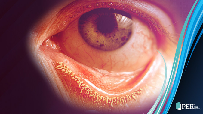 Management of MGD-Associated Dry Eye Disease | myCME