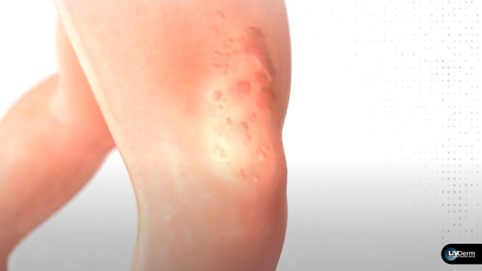 BTK Inhibition for Chronic Spontaneous Urticaria | myCME