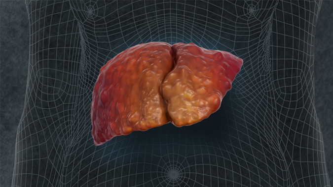 HCC Diagnosis and Management | myCME