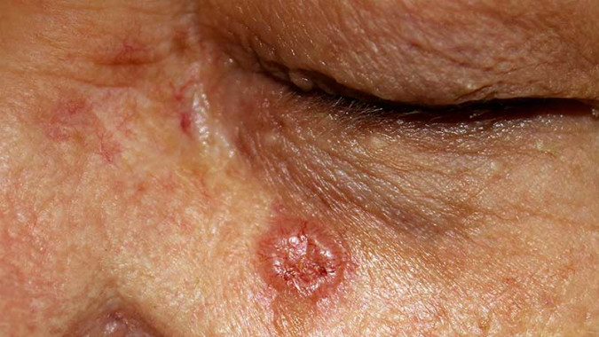 Advanced Basal Cell Carcinoma: How to Navigate Challenging Clinical ...