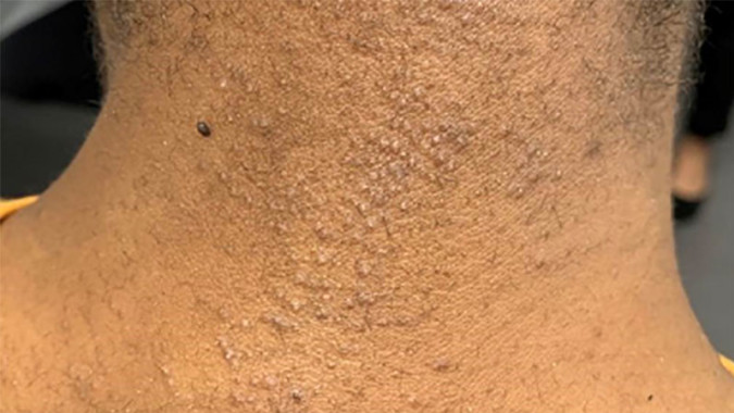 Management and Treatment of Atopic Dermatitis in Patients of Color