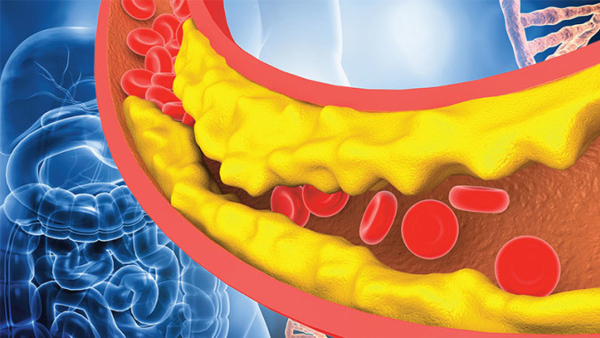 Primary Care and Dyslipidemia: What Should You Do? | myCME