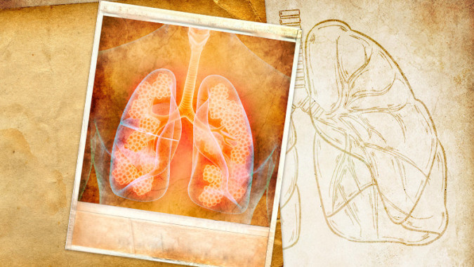 Fighting to Breathe: Ensuring Quality COPD Care for All | myCME