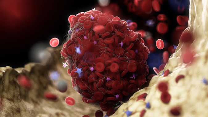 A 50-Year-Old Man with Symptoms of Acute Lower GI Bleeding | myCME