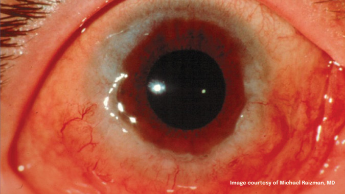 An Eye to Optimal Treatment Targeting for Vernal Keratoconjunctivitis