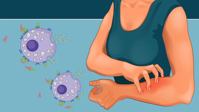 Chronic Urticaria Management: Best Practices | myCME