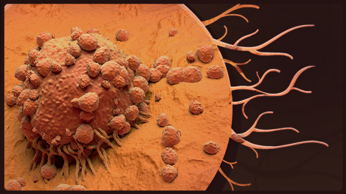 Personalized Pathways for Treating Advanced Melanoma | myCME