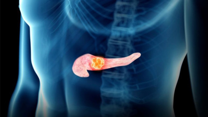 Pancreatic Cancer Screening and Personalized Therapy | myCME