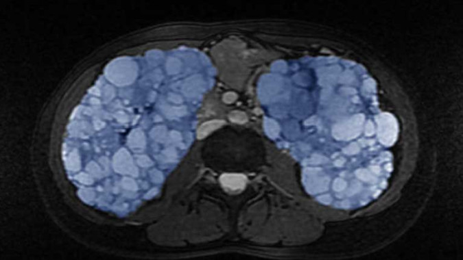 Imaging in ADPKD: Diagnosis, Risk Stratification, and Monitoring | myCME