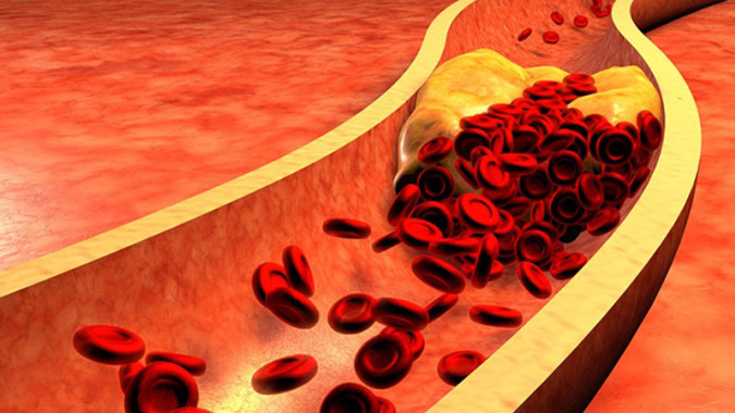 Highlights in Hypercholesterolemia – Part 1 | myCME