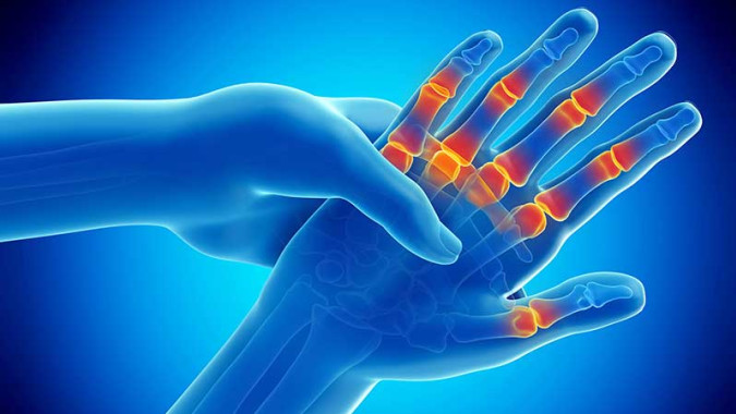 A Closer Look at Evolving Treatment Strategies for Rheumatoid Arthritis ...