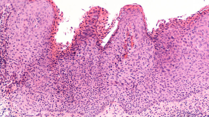 Advanced Cutaneous Squamous Cell Carcinoma in the Era of Systemic ...