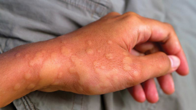 Chronic Idiopathic Urticaria: Therapeutic Possibilities | myCME