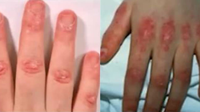 Myositis Phenotypes in Children and Adults | myCME