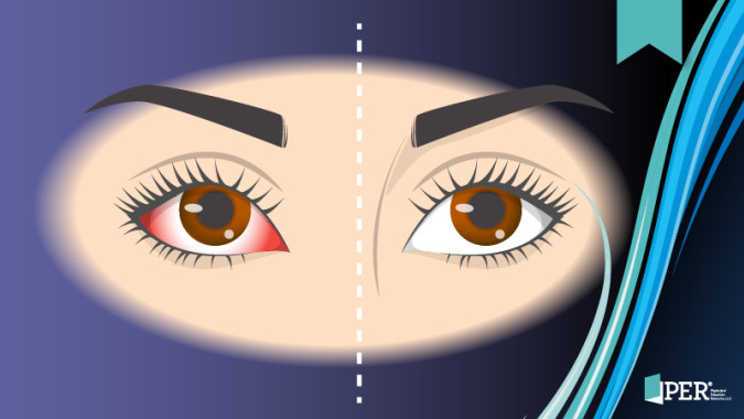 Individualizing Care in Allergic Conjunctivitis | myCME