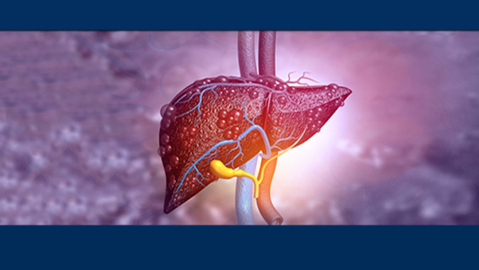 New Advances in Diagnosis and Management of NASH | myCME