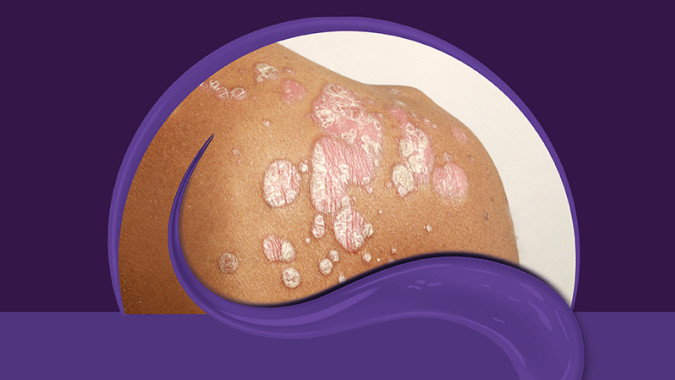 Topical Treatments for Psoriasis: Tapinarof and Roflumilast | myCME