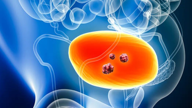 New Immunotherapy Approaches for Bladder Cancer | myCME New Immunotherapy Approaches for Bladder Cancer | myCME