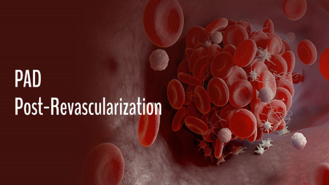 Advances for Patients with PAD Post-Revascularization | myCME