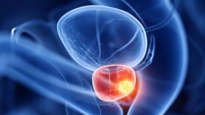 PARP Inhibitors for Metastatic Prostate Cancer | myCME