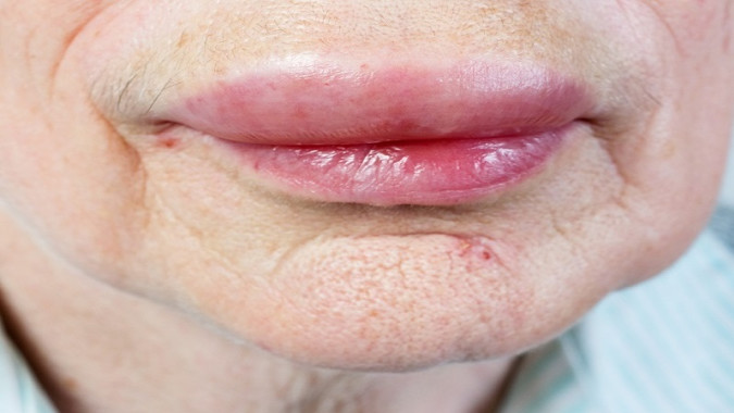 Hereditary Angioedema Individualized Treatment and Access | myCME