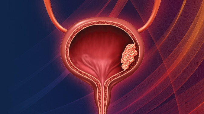 State of the Art Management of Bladder Cancer | myCME