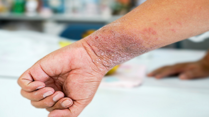 Diagnosing and Managing Atopic Dermatitis | myCME