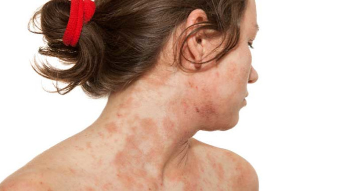 A Deeper Look at Atopic Dermatitis in Adolescents: Case Study | myCME