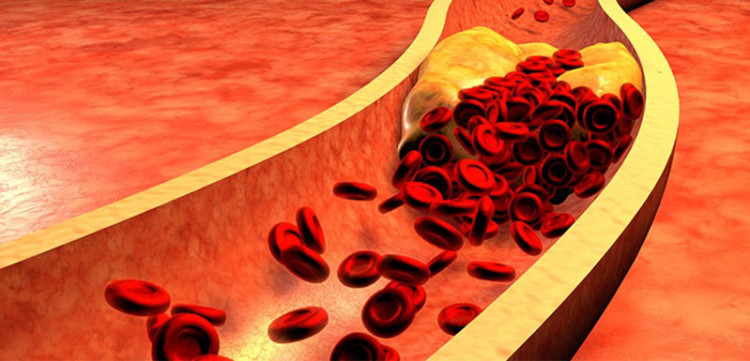 What's New in Hypercholesterolemia CME/CE Online Course | myCME