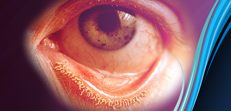 Eye Disorders CME - Free Eye Disorders Courses Online | myCME